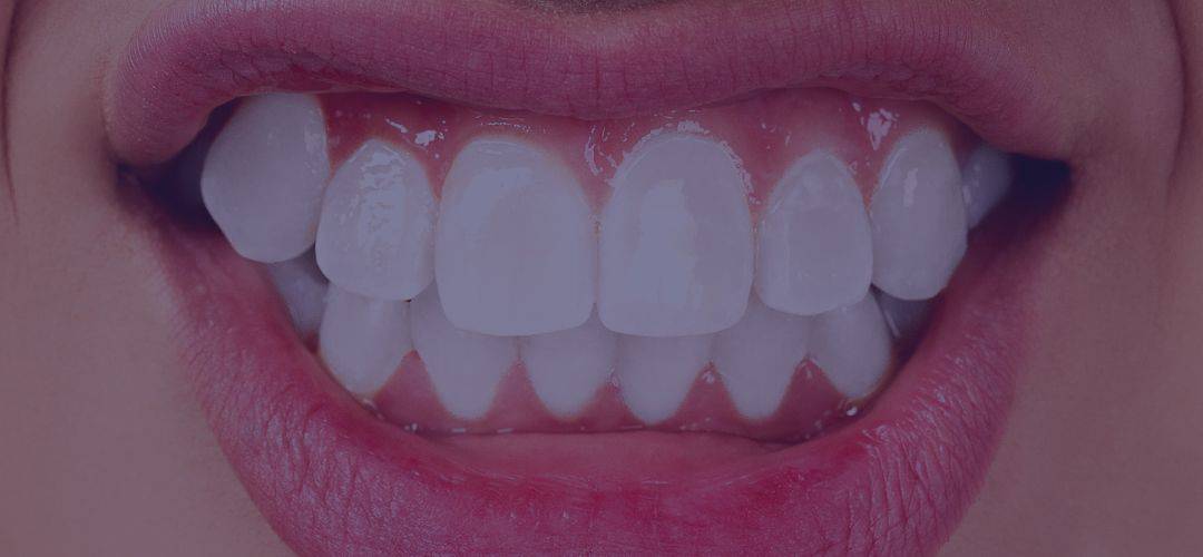 The true cost of clenching and grinding your teeth - Expat Dental